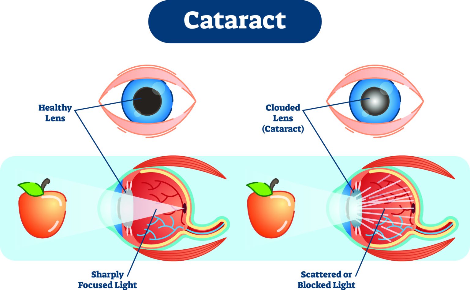June is Cataract Awareness Month - Discovery Eye Foundation