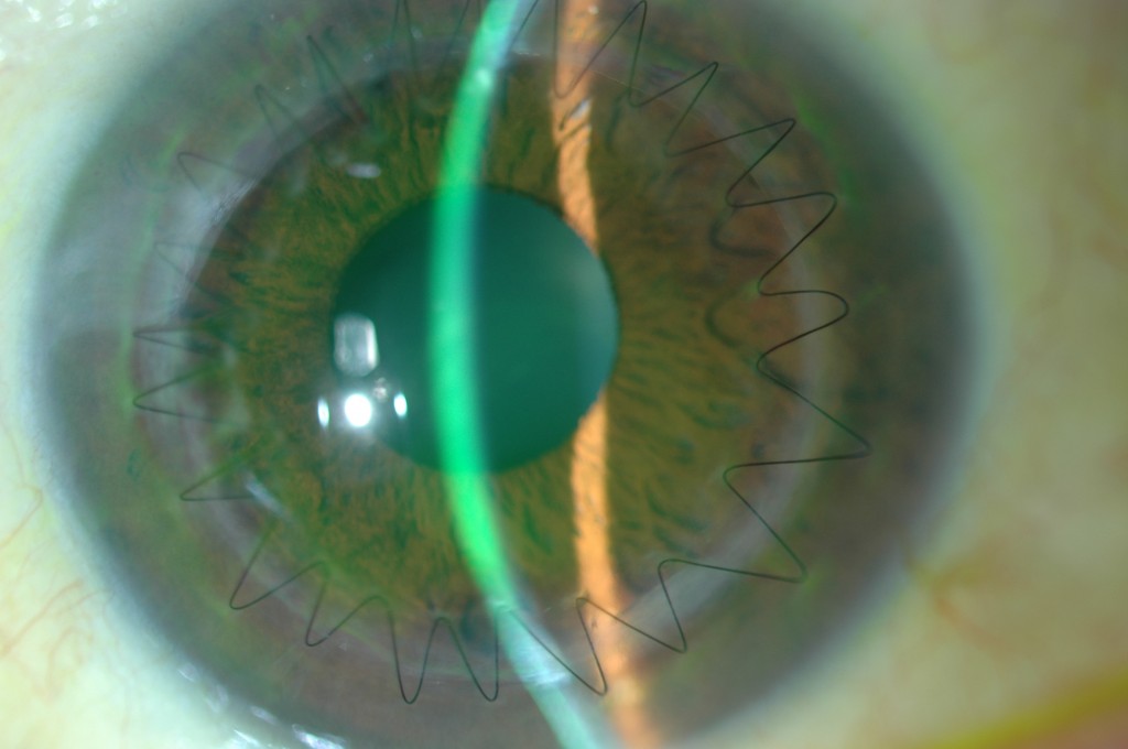 Corneal Transplant Surgery Options - Discovery Eye Foundation