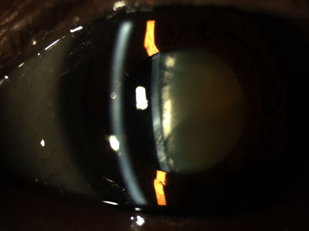 What You Need to Know About Cataracts - Discovery Eye Foundation