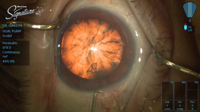 What You Need to Know About Cataracts - Discovery Eye Foundation