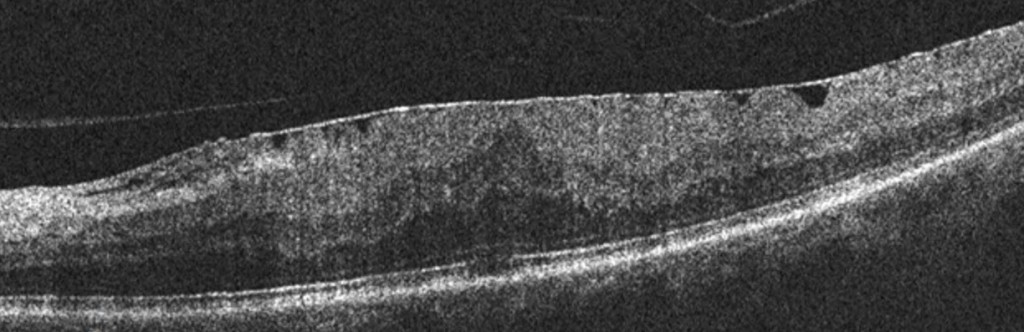 What Are A Macular Pucker and Macular Hole? - Discovery Eye Foundation