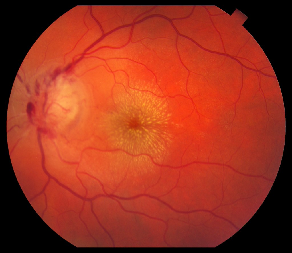Uveitis Explained - Discovery Eye Foundation