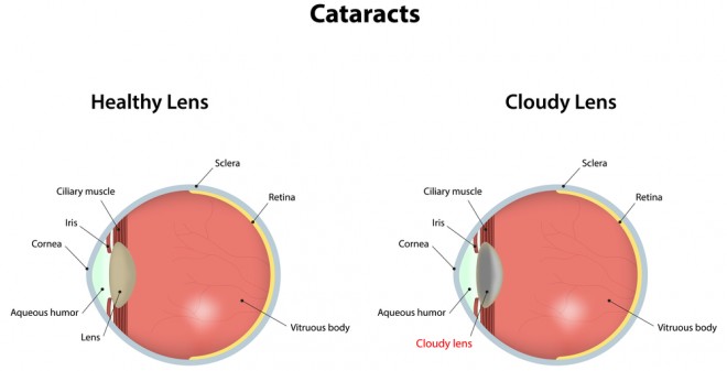 Cataract Prevention - Discovery Eye Foundation