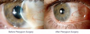 Do You Have a Pterygium? - Discovery Eye Foundation