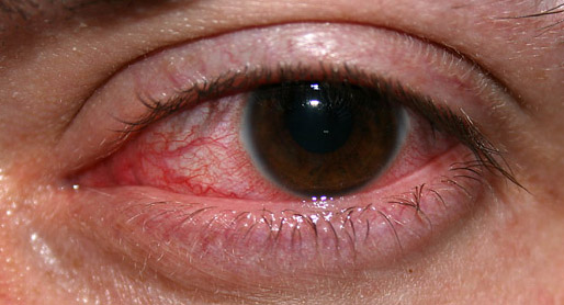 Symptoms of Dry Eye Disease - Discovery Eye Foundation