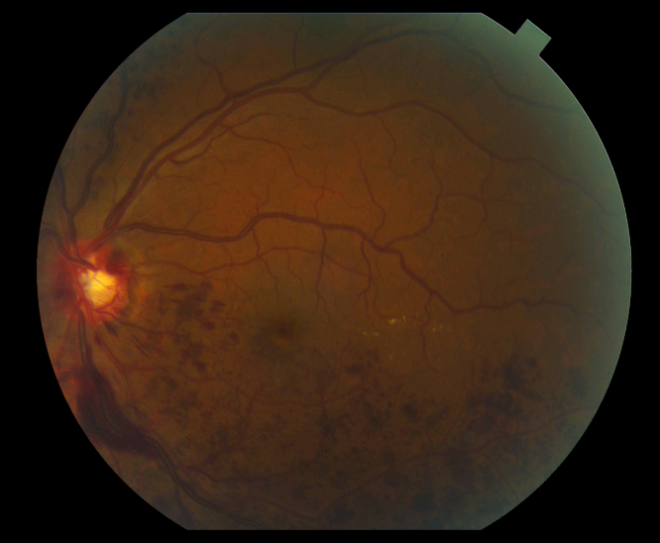 Retinal Vascular Occlusions - Discovery Eye Foundation